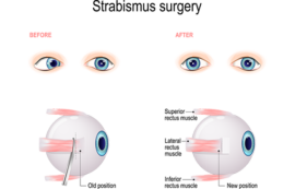Adult Strabismus Seattle | Strabismus Doctor Seattle, WA | EANW