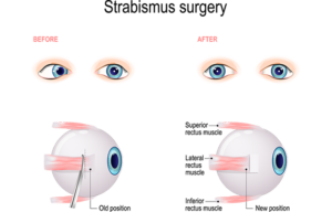 Adult Strabismus Seattle | Strabismus Doctor Seattle, WA | EANW